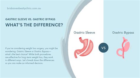 Gastric Sleeve Vs Gastric Bypass Whats The Difference Weight Loss Surgery Brisbane