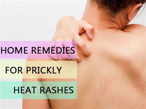 11 Effective Home Remedies For Heat Rash Prickly Heat