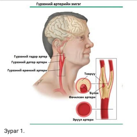 Судас хатуурал гэж юу вэ Хүний биеийн артерийн судасны дотор хананд өөхөн дуслууд хуримтлагдаж