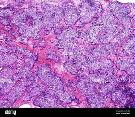 Carcinoma Of The Ovary Light Micrograph Stock Photo Alamy
