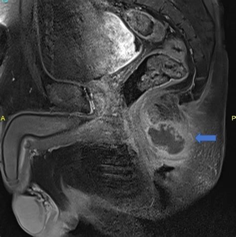 Anal Abscess Due To Leech Therapy Of Hemorrhoids Mumbo Jumbo Is Still In Vogue Abstract