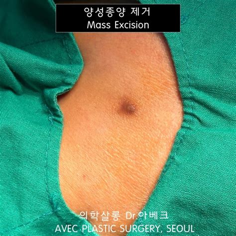 목 사마귀 제거 【dr 아베크 양성종양】 네이버 블로그