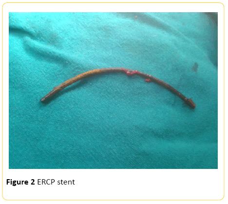 Ercp Stent