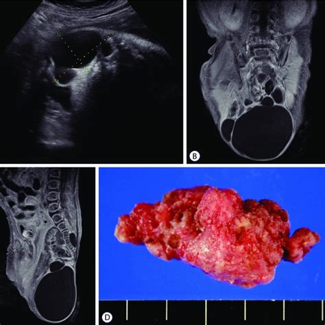 Altman Classification Of Sacrococcygeal Teratoma According To The Download Scientific Diagram