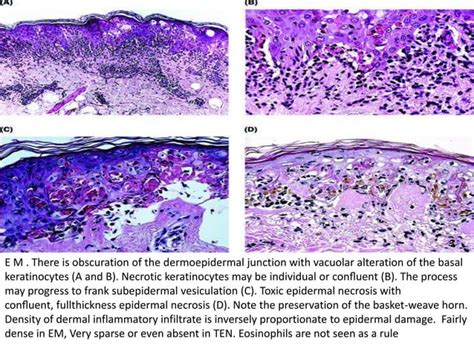 Interface Dermatitis Tutorial Pptx Skin And Dermatology Diseases