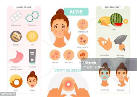 Acne Infographic Vector Stock Illustration Download Image Now Acne
