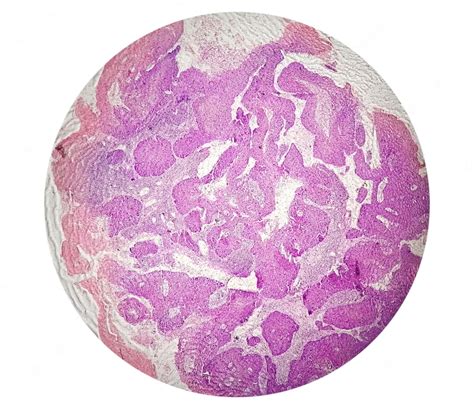 Premium Photo Photomicrograph Showing Tongue Squamous Cell Carcinoma Grade Ii Oral Invasive Scc