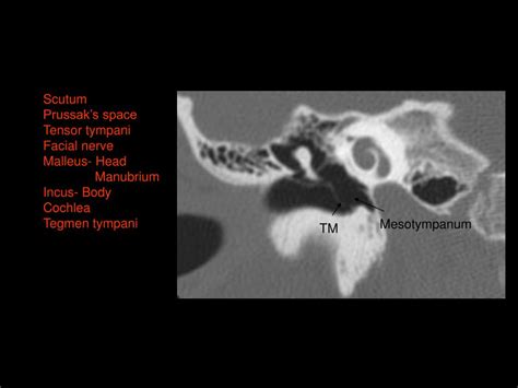 Ppt Ct Temporal Bone Powerpoint Presentation Free Download Id 3204041