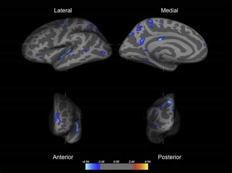 Fmri Adhd Cortex Thickness Neuroscience News