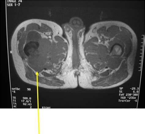 Dedifferentiated Chondrosarcoma Bone Tumor Cancer Tumors Of The Bone