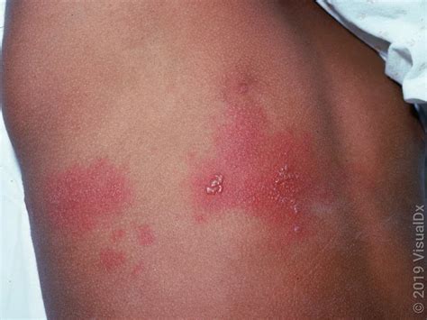 What Does Shingles Look Like Rash Stages With Pictures Goodrx