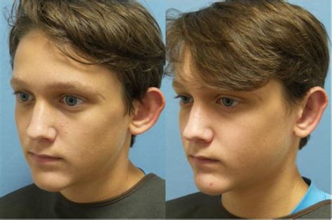 Understanding Otoplasty Ear Pinning Surgery Europeanmagazine