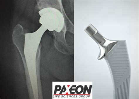 Paxeon Reconstruction Successfully Launches 135º Collared High Offset Ha Hip Stem Selby Spine