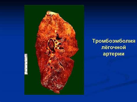 Расстройства кровообращения 2 Тромбоз Пристеночный