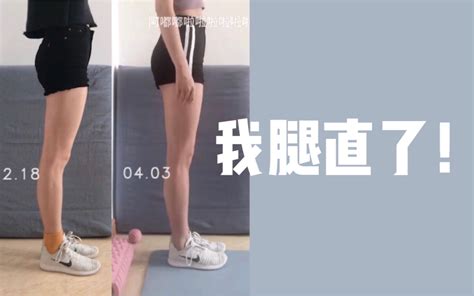 真实经验分享总结 膝超伸、大腿前侧粗壮凸出、骨盆前倾改善、小腿肚向后凸出女团腿 腿不直腿直了后还长高了一丢丢嘿嘿嘿嘿嘿哔哩哔哩bilibili