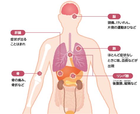 腎細胞がんrccの転移と再発 患者の皆様 武田薬品工業株式会社
