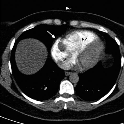 Intracardiac Leiomyomatosis An Unusual Cause Of Syncope In A Middle