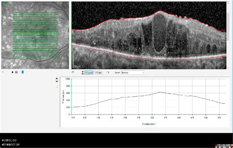 Right Eye Oct Prior To Intravitreal Iluvien™ Implant Description Oct