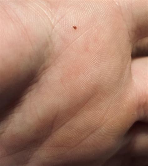 Spot On Palm Of Hand Should I Get It Looked At R Skincancer