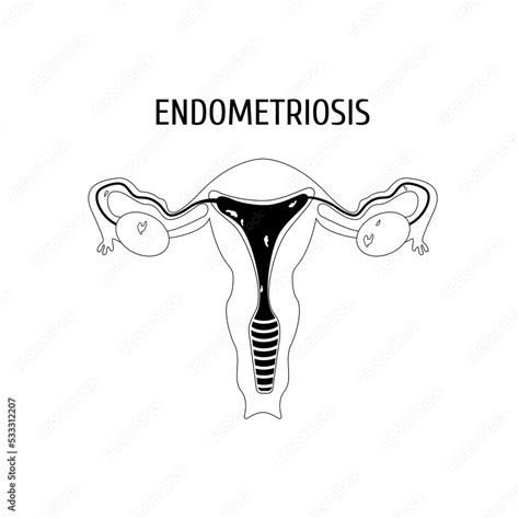 Endometriosis Female Genitals Outline Stock Vector Adobe Stock