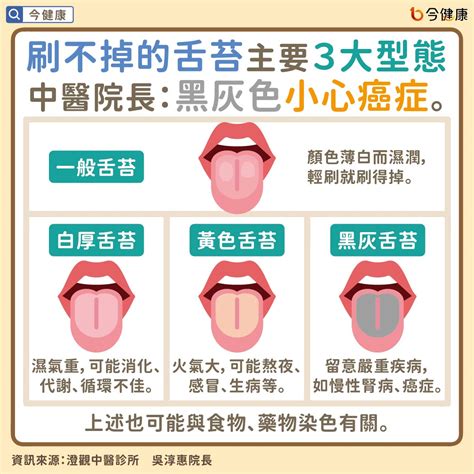 舌苔刷不掉怎麼辦中醫院長指原因按穴位泡腳助改善 今健康