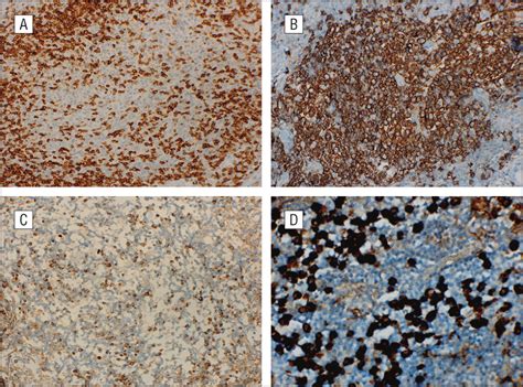 Igg4 Positive Dacryoadenitis And Küttner Submandibular Sclerosing