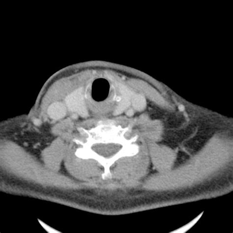 Radiopaedia Case Suppurative Lymphadenitis Id 74151 Study 84966 Nc