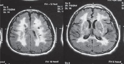 Axial Flair Image Diffuse Hypersignal Of Periventricular And