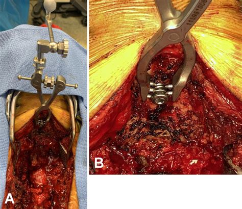 Surgical Management Of Grisel Syndrome In The Adult Patient