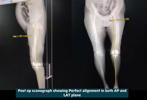 Deformity Corrections Knee And Foot Dr Rachit Sheth