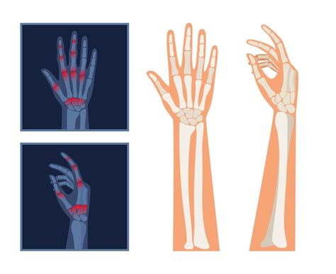 Ilustración Del Vector De La Artritis De Los Dedos Artritis Reumatoide