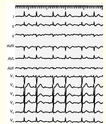 Quand proposer une ablation de première intention dans le flutter