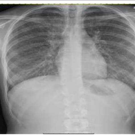 Cxr Coarsening Of Interstitial Lung Markings With Reticulonodular