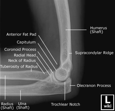Lateral Radiograph Of The Elbow With Labels Radiology Medical