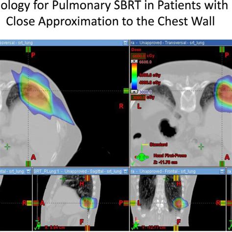Demonstrates Improvement In Dosimetry In A Lesion In The Anterior Download Scientific Diagram