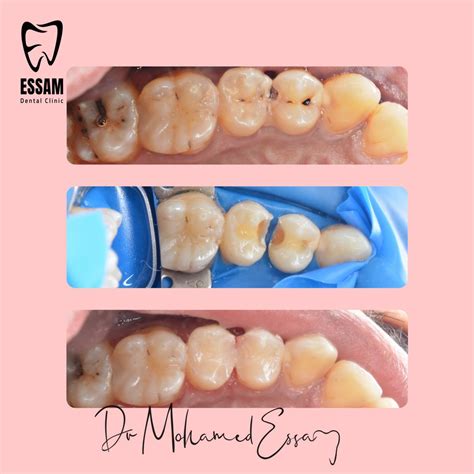 Mohamed Essam Ezzat On Linkedin Composite Dentalcare Dental