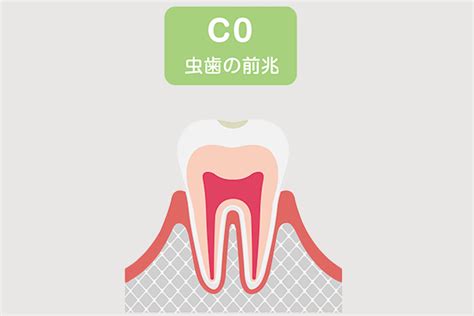 虫歯の症状原因 馬橋歯科医院
