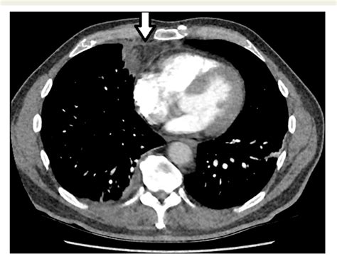Figure 1 From Case Report Epipericardial Fat Necrosis—a Rare Cause Of