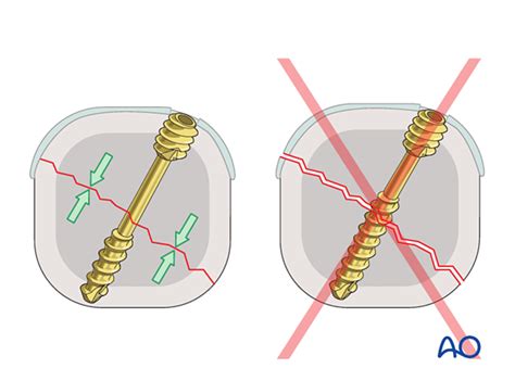 Headless Compression Screw Insertion