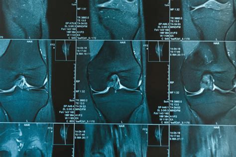 Resonancia Magnética Lumbar en Mérida CMA Hospital