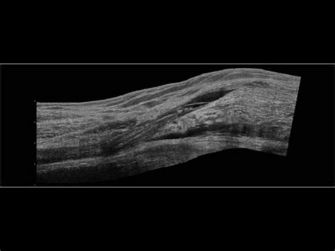 Musculoskeletal Joints And Tendons 61 Shoulder Case 612 Biceps