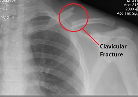 X Ray Broken Collar Bone