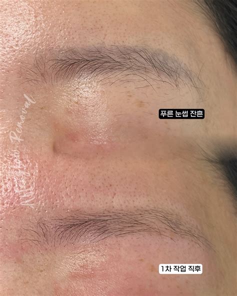 잔흔제거 눈썹문신제거 아이라인제거 반영구제거 부천잔흔제거 부천눈썹잔흔제거 부천눈썹문신제거 🤍𝘽𝙧𝙤𝙬 𝙍𝙚𝙢𝙤𝙫𝙖𝙡🤍 눈썹