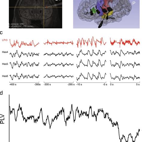 Pdf Seizure Localization Using Pre Ictal Phase Amplitude Coupling In Intracranial