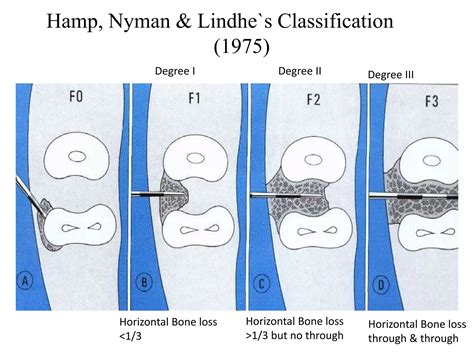 Bone Defects In Different Periodontal Disease Pptx Bone And Joint Conditions Diseases And