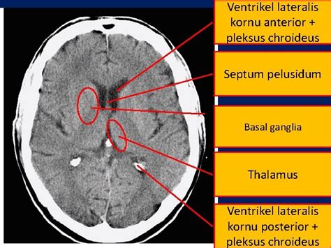 Melaporkan Hasil Ct Scan Kepala Pada Pasien Stroke