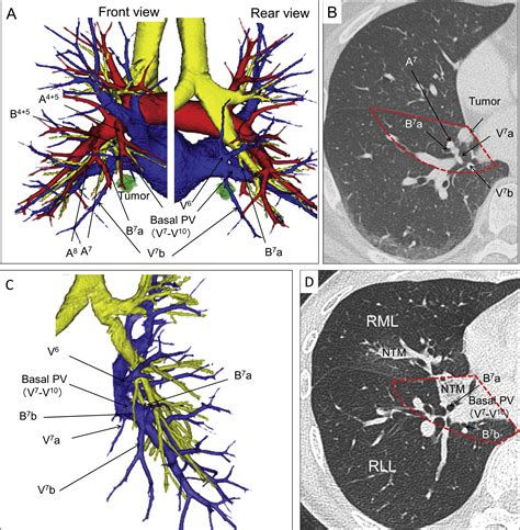 Thoracoscopic Medial Basal Segment Segmentectomy The Annals Of