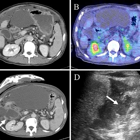 Figure4 Imaging Of The First Gallbladder Perforation Ct Revealed No Download Scientific