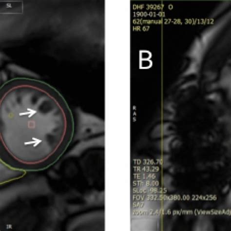 A Point Of Care Ultrasonography Echocardiogram In Subxiphoid 4 Chamber