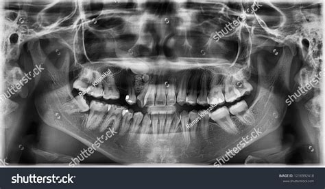 Odontoma Treatment